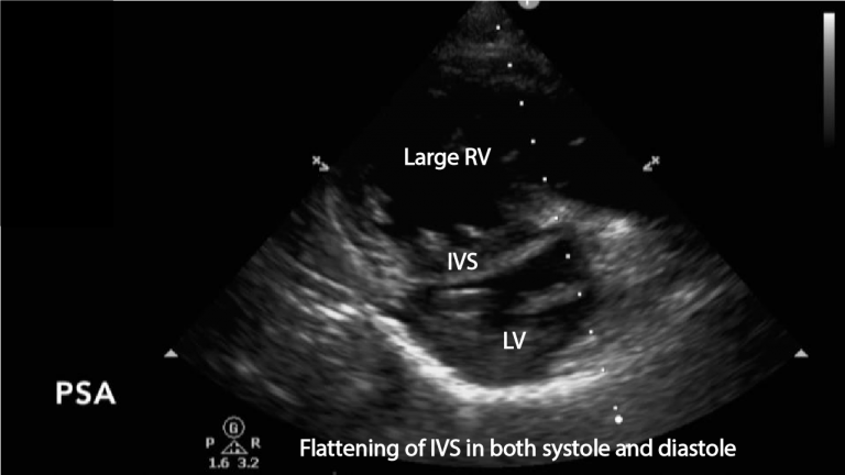 Pulmonary hypertension in a child - Critical Care Sonography
