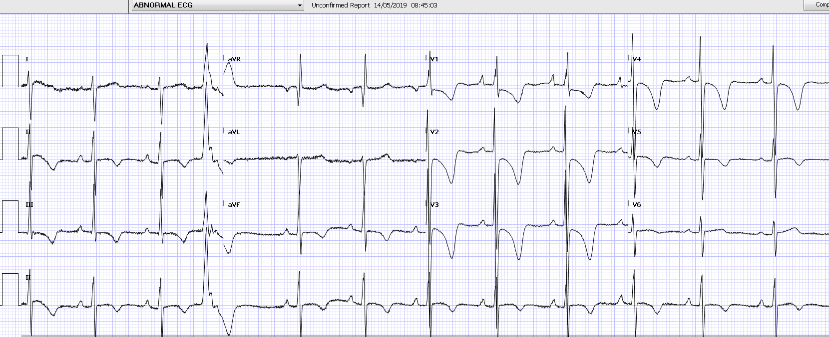 Pulmonary hypertension in a child - Critical Care Sonography