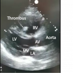 Pulmonary Embolism - Right ventricular thrombus - Critical Care Sonography