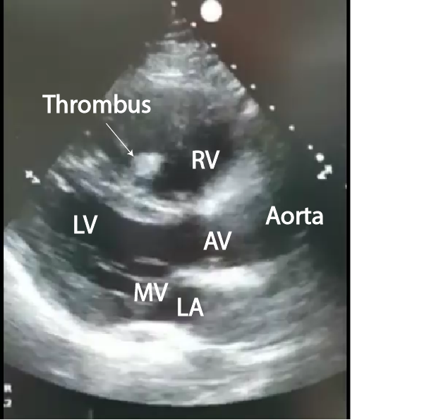 Pulmonary Embolism - Right ventricular thrombus - Critical Care Sonography