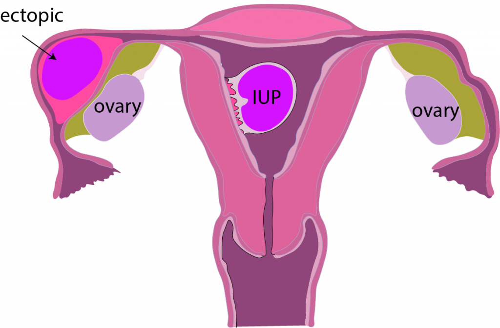 Heterotopic pregnancy - Critical Care Sonography