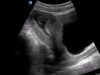 Ruptured ectopic, pseudosac - Critical Care Sonography