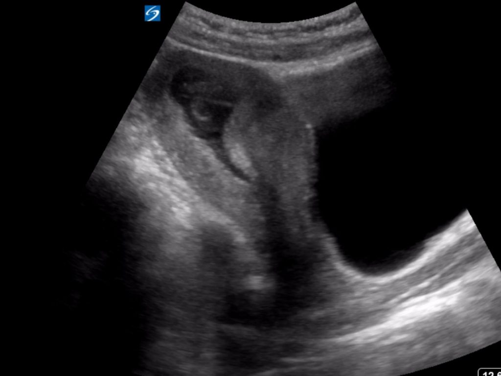 Ruptured ectopic, pseudosac - Critical Care Sonography