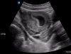 Ruptured ectopic, pseudosac - Critical Care Sonography