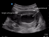 Ruptured ectopic, pseudosac - Critical Care Sonography
