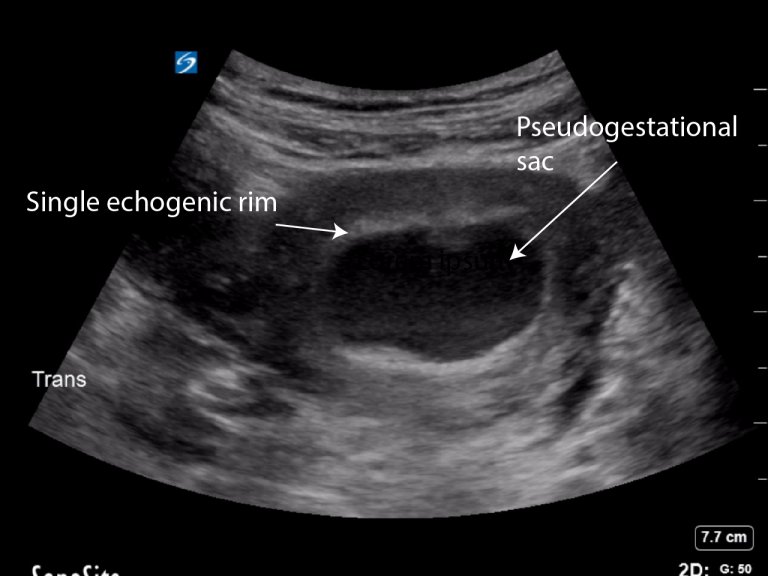 Ruptured ectopic, pseudosac - Critical Care Sonography