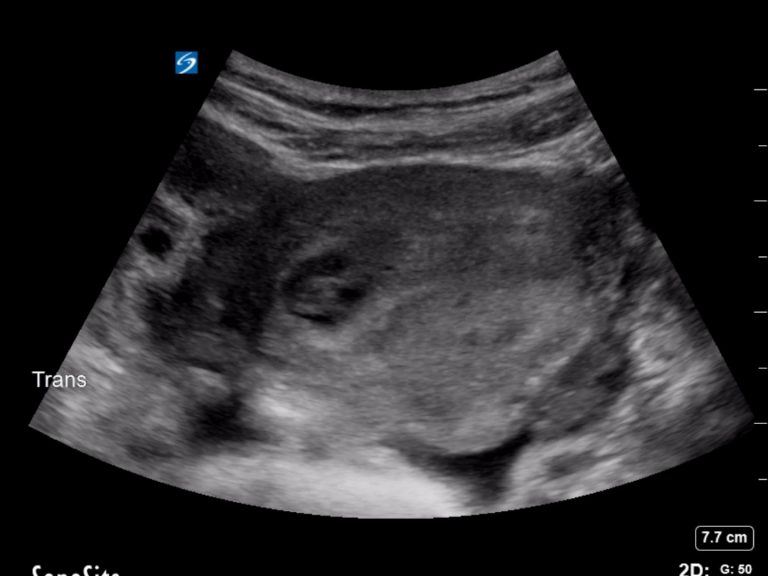 Ruptured ectopic, pseudosac - Critical Care Sonography