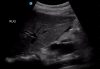 Ruptured ectopic, pseudosac - Critical Care Sonography