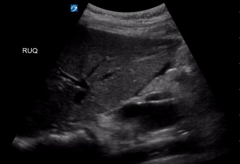 Ruptured ectopic, pseudosac - Critical Care Sonography