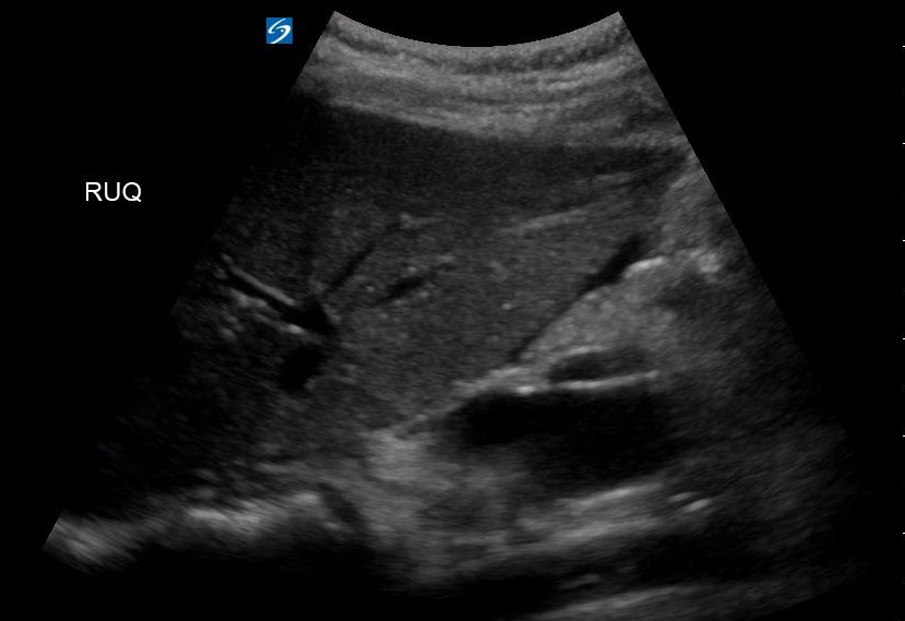 Ruptured ectopic, pseudosac - Critical Care Sonography