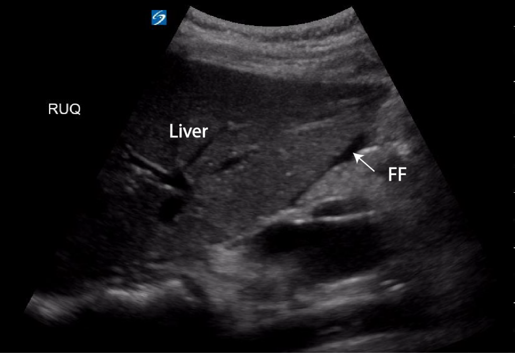Ruptured ectopic, pseudosac - Critical Care Sonography