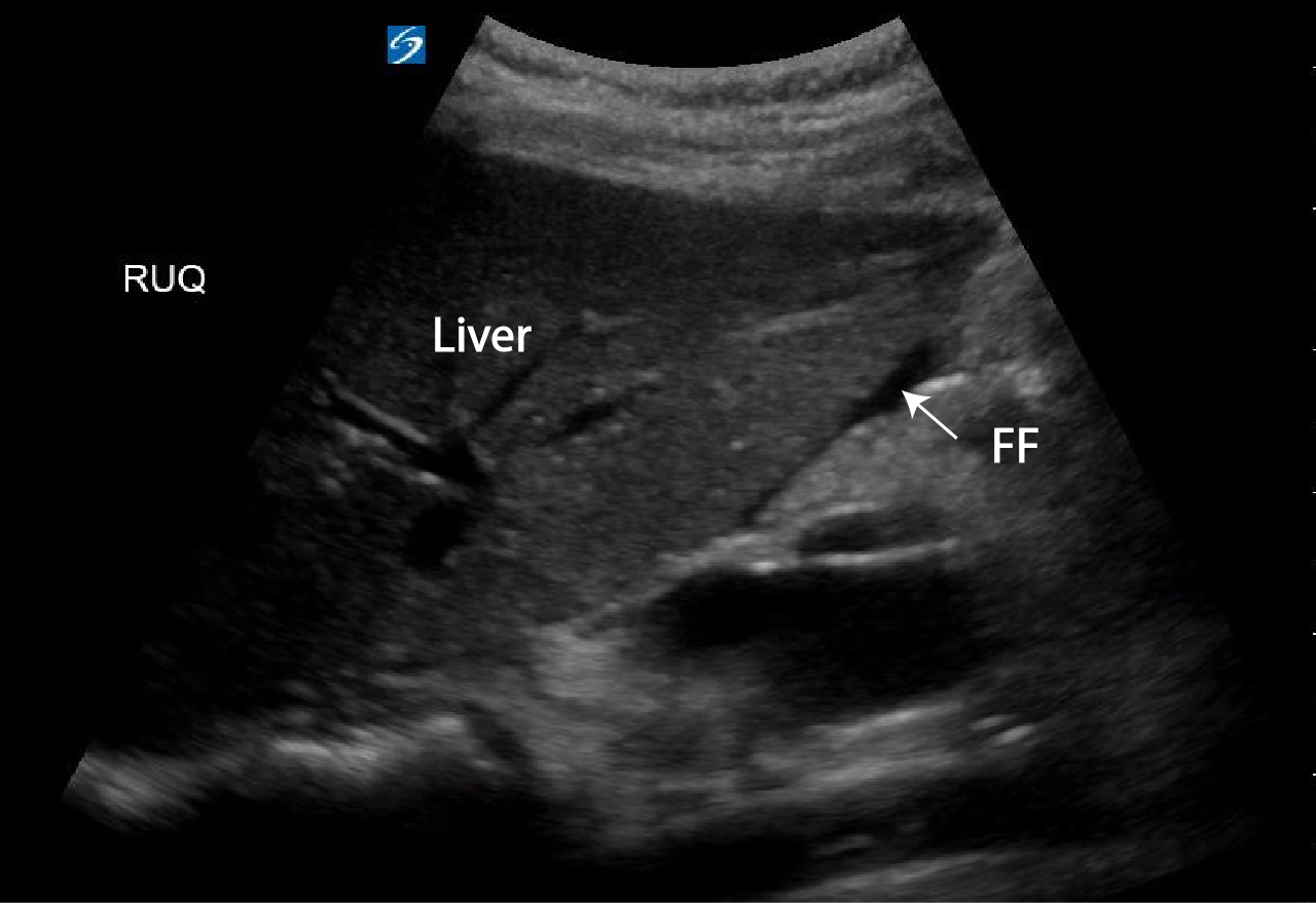 Ruptured ectopic, pseudosac - Critical Care Sonography