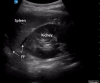 Ruptured ectopic, pseudosac - Critical Care Sonography