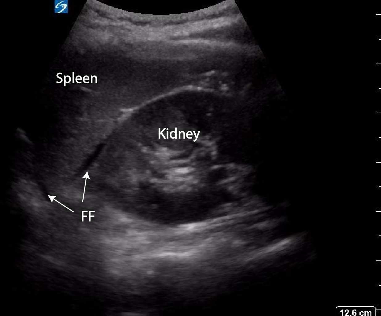 Ruptured ectopic, pseudosac - Critical Care Sonography