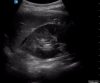 Ruptured ectopic, pseudosac - Critical Care Sonography