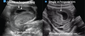 Ruptured ectopic, pseudosac - Critical Care Sonography