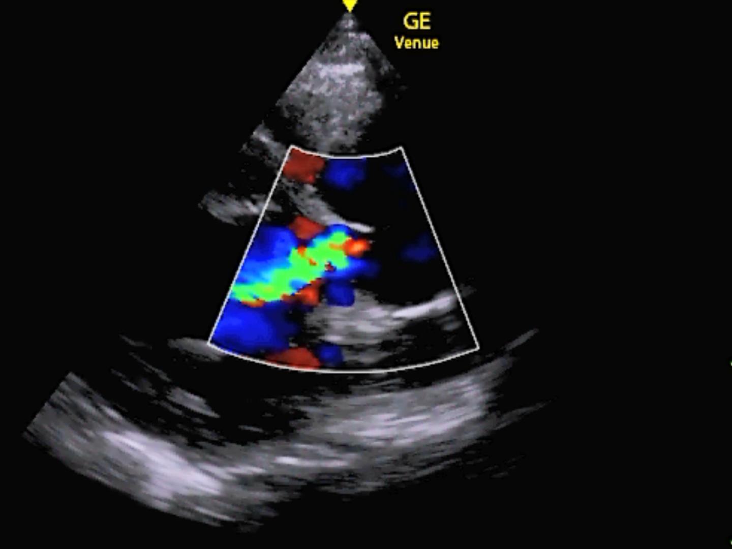 Aortopathy - Aortic root dilatation - Critical Care Sonography
