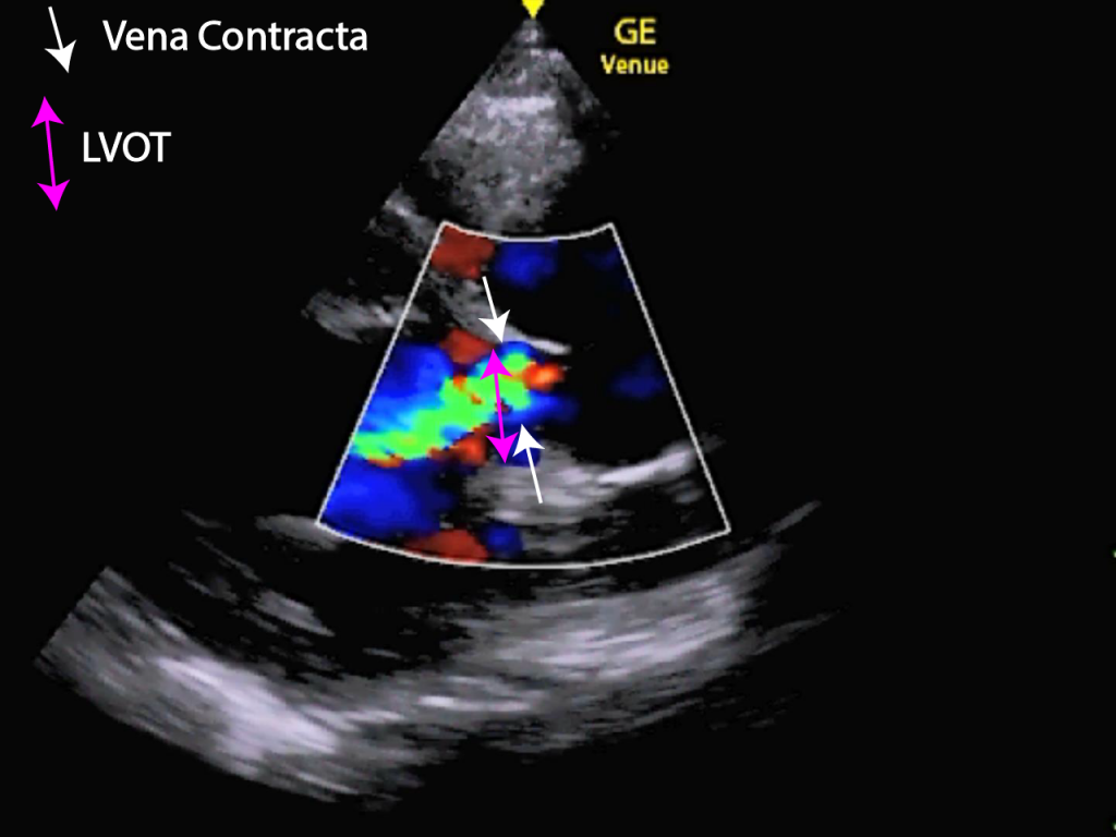 Aortopathy - Aortic root dilatation - Critical Care Sonography