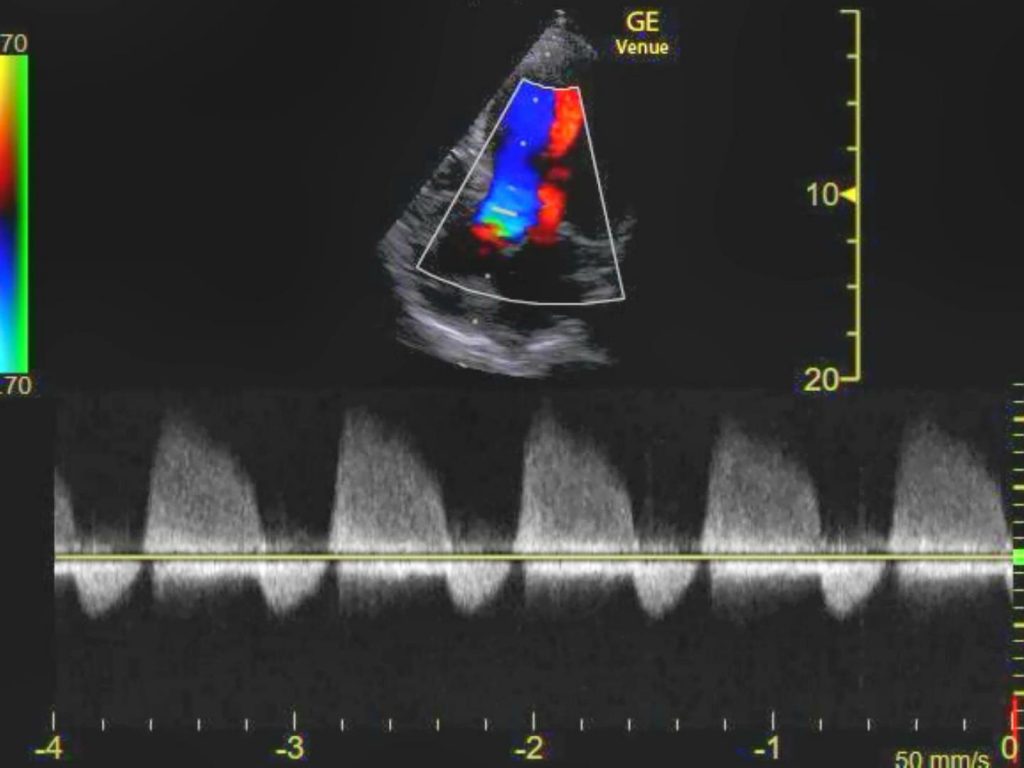 Aortopathy - Aortic root dilatation - Critical Care Sonography