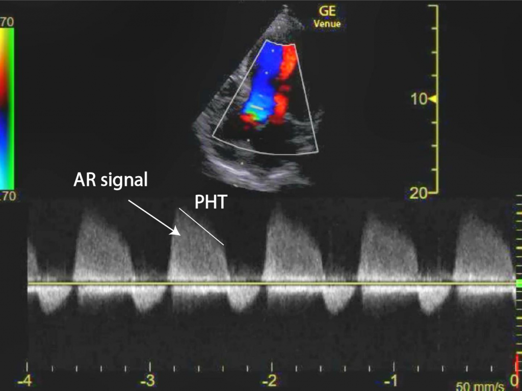 Aortopathy - Aortic root dilatation - Critical Care Sonography