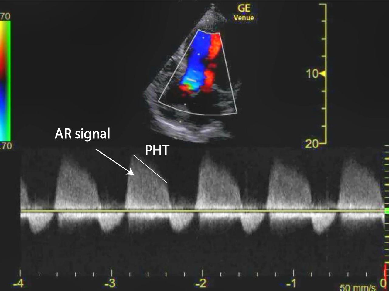 Aortopathy - Aortic root dilatation - Critical Care Sonography