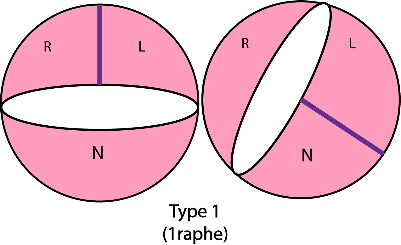 Causes of Aortic Stenosis - Critical Care Sonography