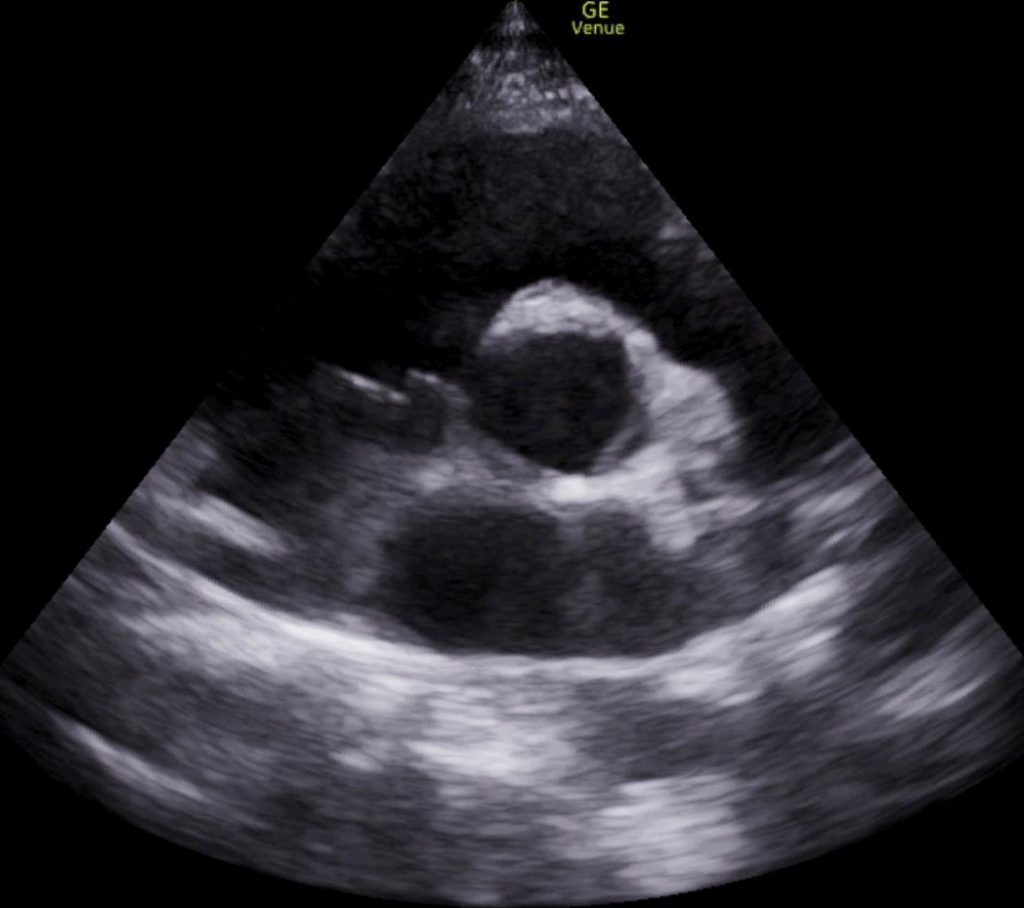 3. Causes of Aortic regurgitation : Congenitally abnormal valves ...