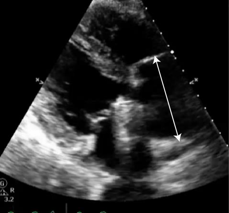 2. Causes of Aortic regurgitation : Aortic root dilatation and Loss of ...