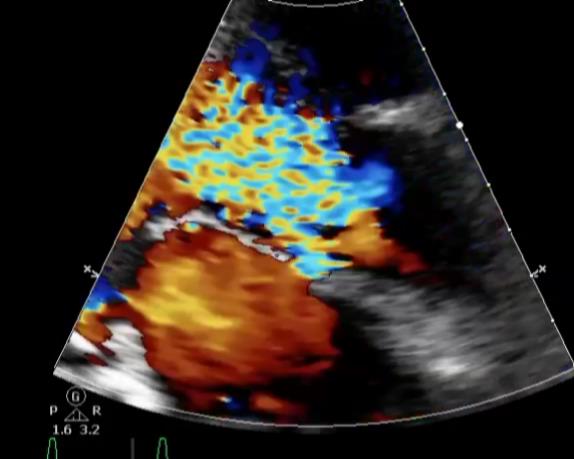 Assessment of aortic regurgitation - Critical Care Sonography