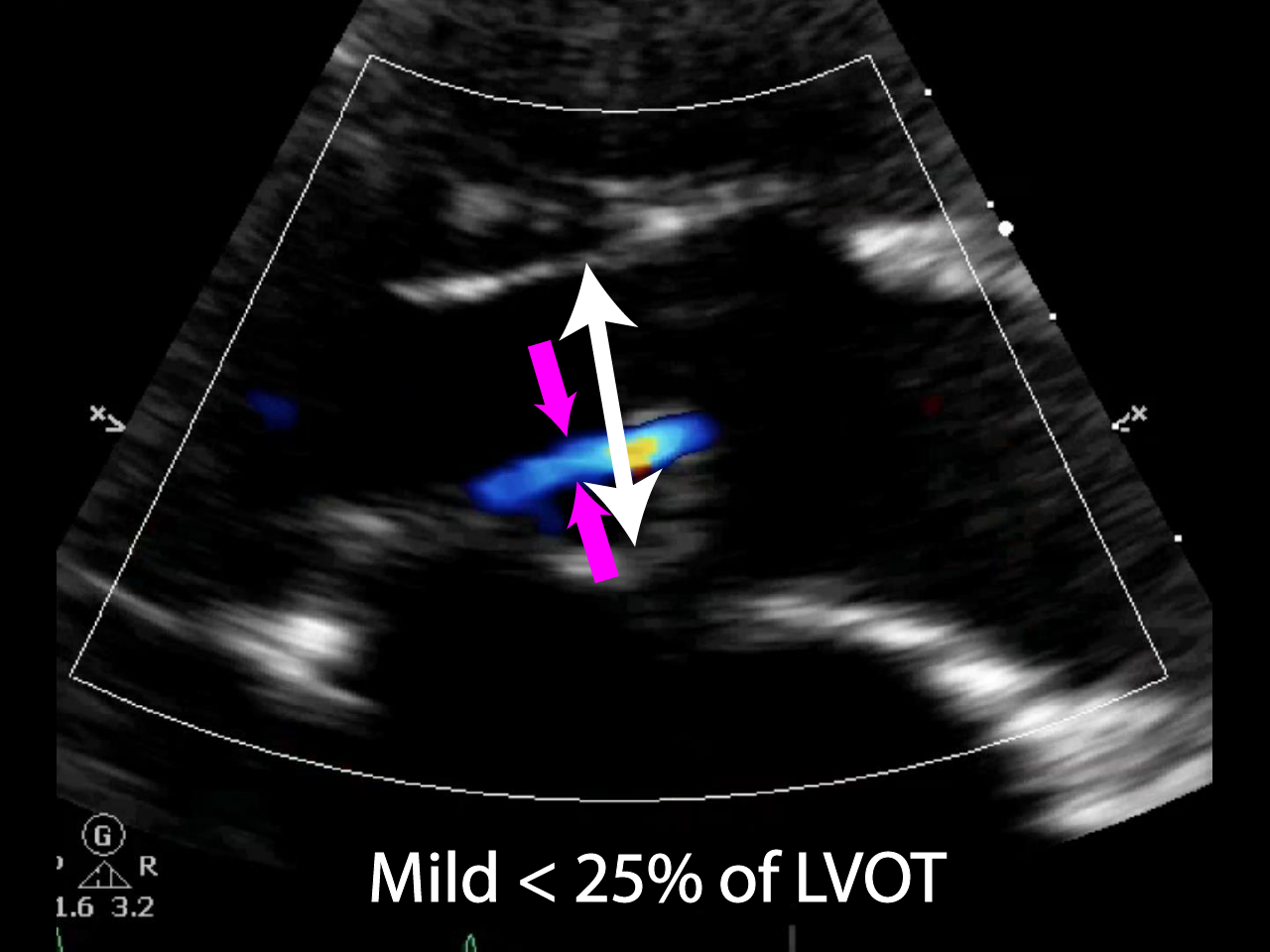Assessment of aortic regurgitation - Critical Care Sonography