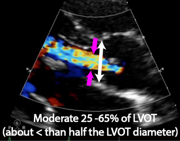 Assessment of aortic regurgitation - Critical Care Sonography