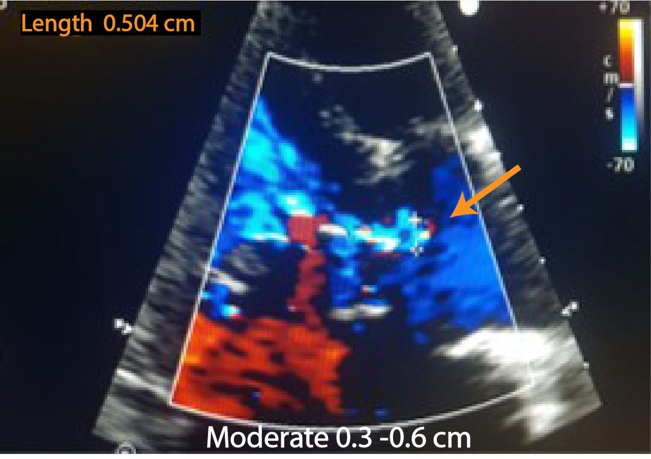 Assessment of aortic regurgitation - Critical Care Sonography