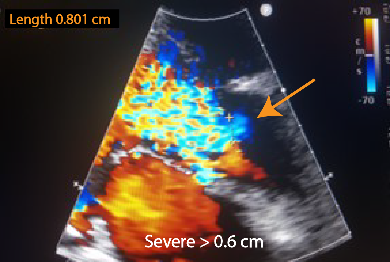 Assessment of aortic regurgitation - Critical Care Sonography