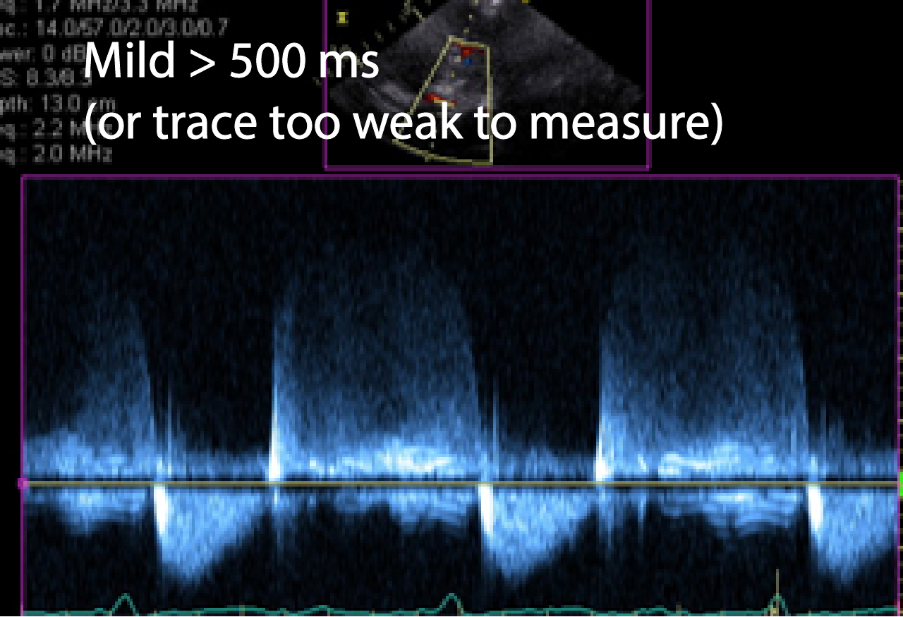 Assessment of aortic regurgitation - Critical Care Sonography