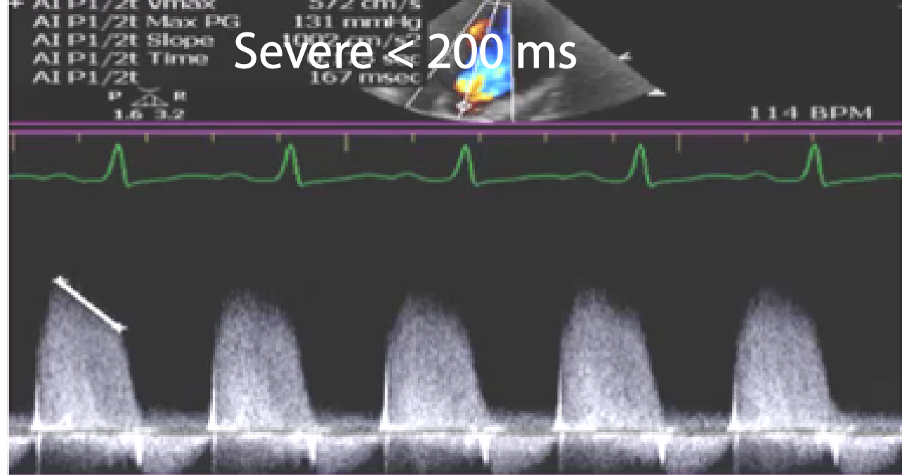 Assessment of aortic regurgitation - Critical Care Sonography