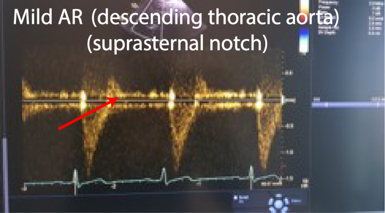 Assessment of aortic regurgitation - Critical Care Sonography