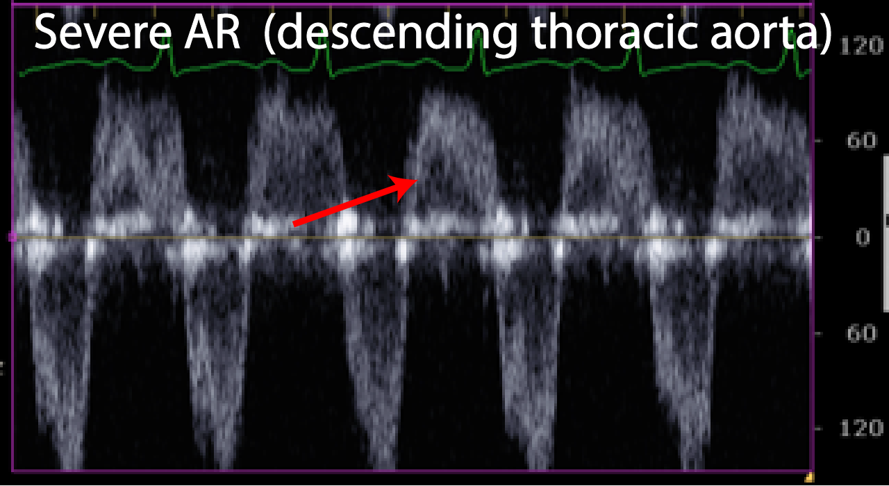 Assessment of aortic regurgitation - Critical Care Sonography