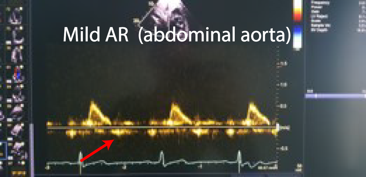 Assessment of aortic regurgitation - Critical Care Sonography