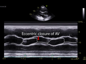 Causes of Aortic Stenosis - Critical Care Sonography