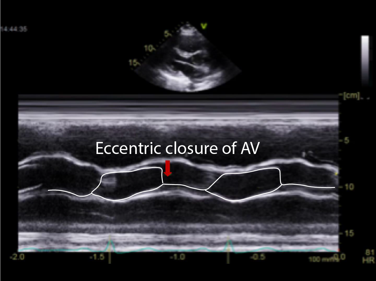 Causes of Aortic Stenosis - Critical Care Sonography