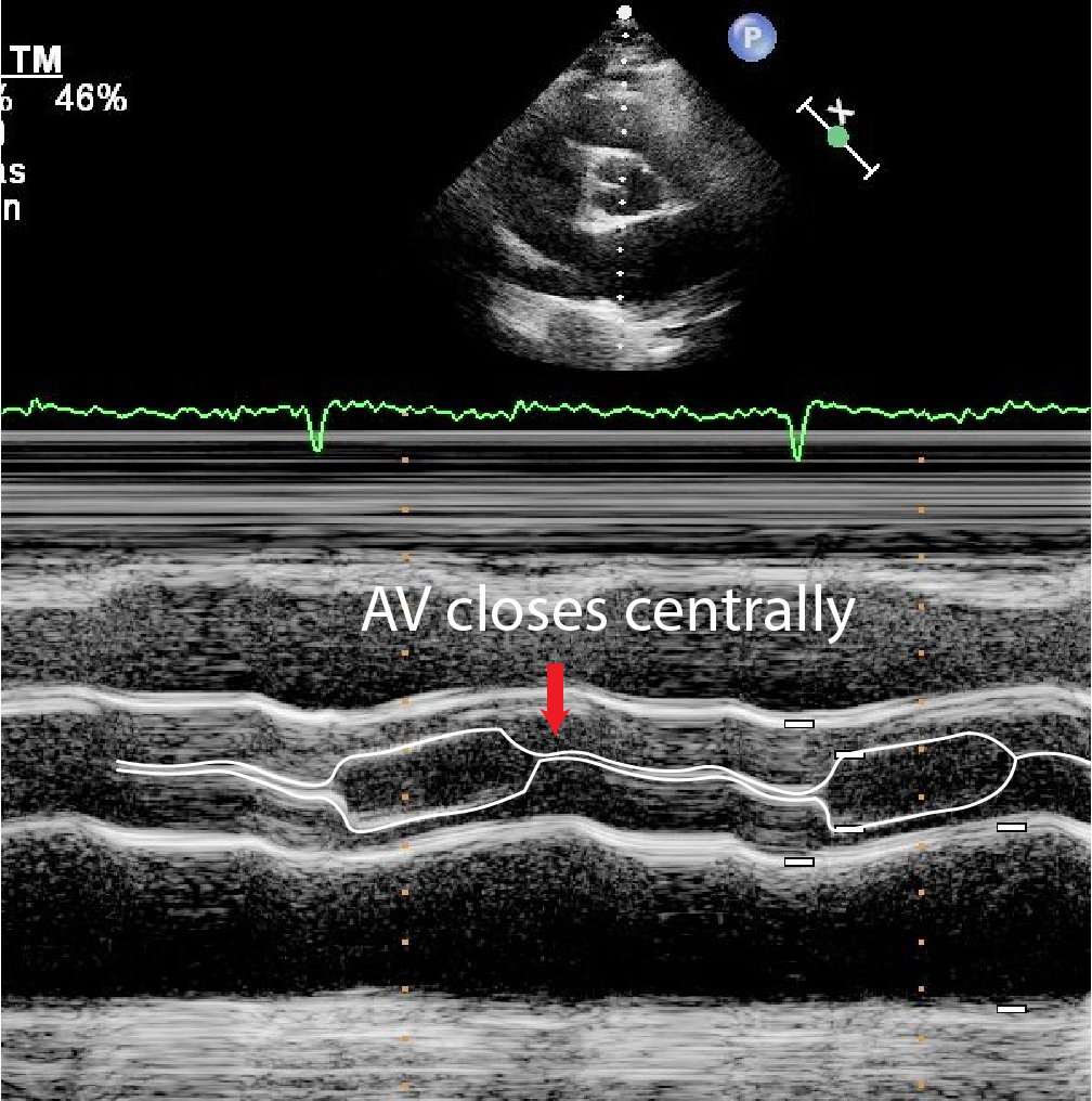 Causes of Aortic Stenosis - Critical Care Sonography