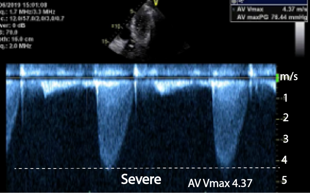 2. Assessment of Severity of AS : Quantitative assessment - Critical ...