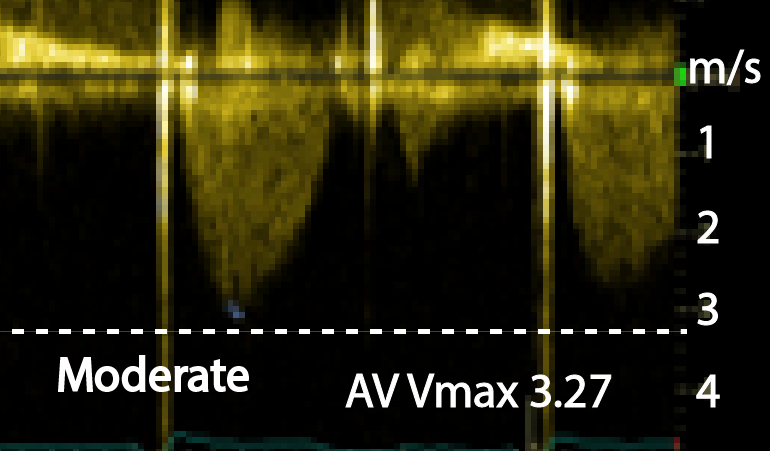 2. Assessment of Severity of AS : Quantitative assessment - Critical ...