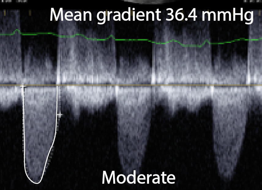 2. Assessment of Severity of AS : Quantitative assessment - Critical ...