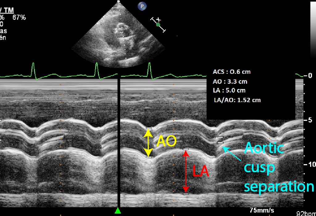 1. Assessment of Severity of AS : 2D assessments - Critical Care Sonography