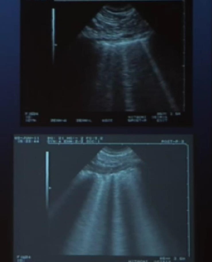 Lung Ultrasound by Dr Lichtenstein - Critical Care Sonography