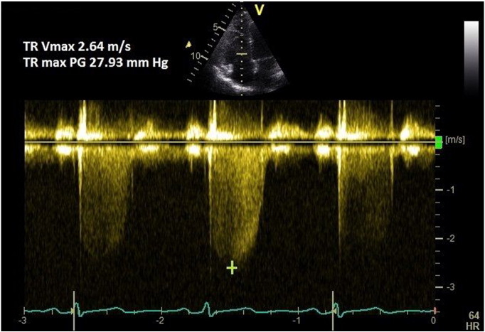 Assessment of RV Quiz - Critical Care Sonography
