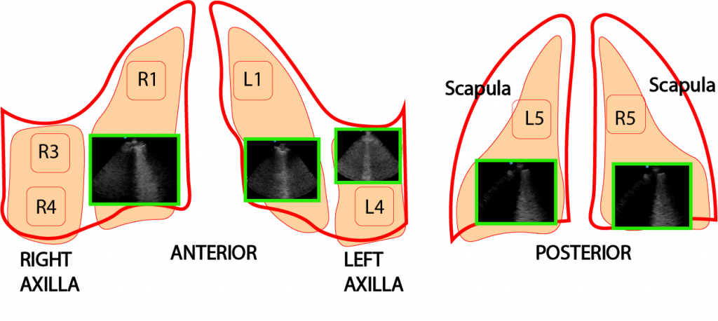 Lung Ultrasound findings in COVID 19 - Critical Care Sonography