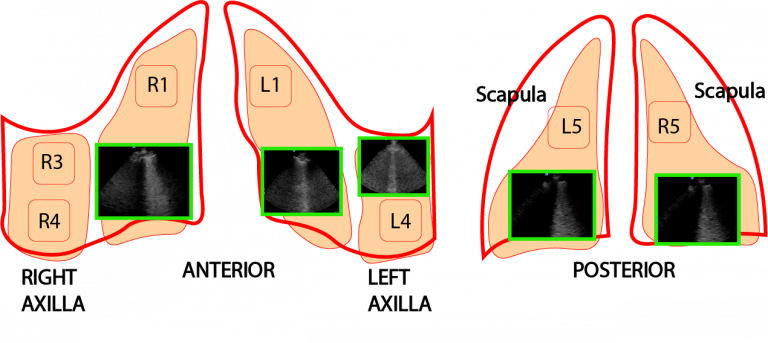 Lung Ultrasound findings in COVID 19 - Critical Care Sonography
