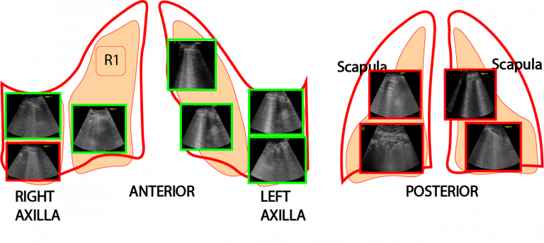 Lung Ultrasound findings in COVID 19 - Critical Care Sonography